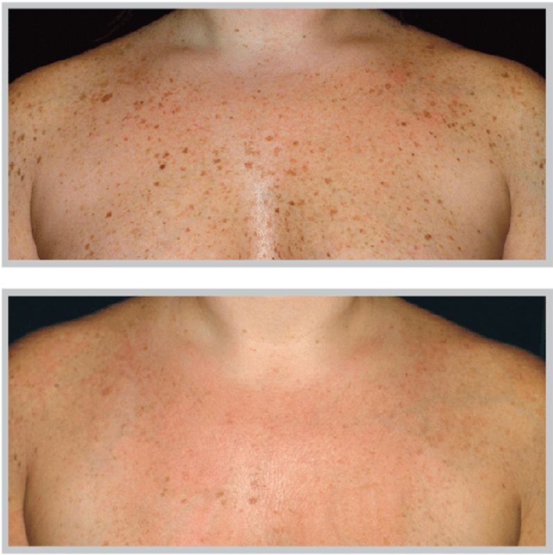 FotoFacial BBL/IPL - Age Management and Aesthetic Clinic, Newport Beach, CA